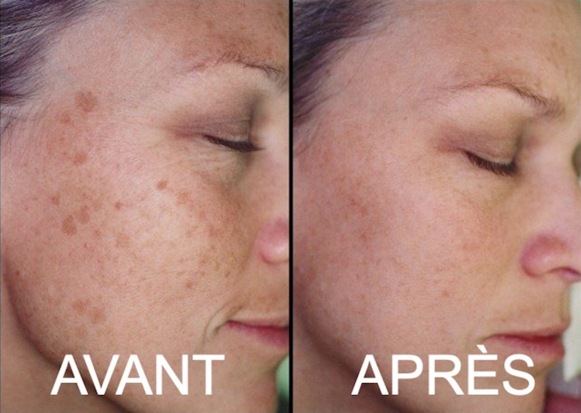 Comment enlever les taches brunes sur le visage - Le guide ultime